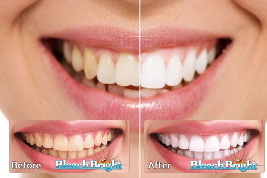 Bleach Bright Teeth Whitening - ChillRx Cryotherapy Montclair